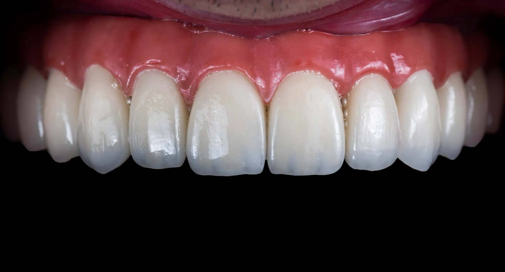 All-on-4 Dental Implants - Implant Denture - Amazing Smiles