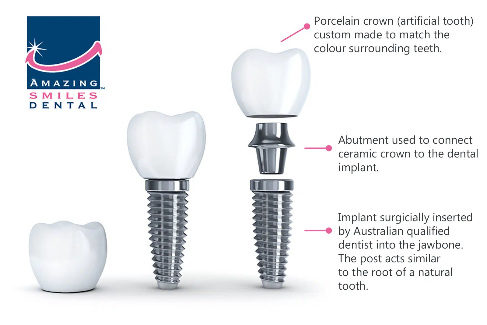 Single Tooth Implant - Book A Free Dental Implant Consult