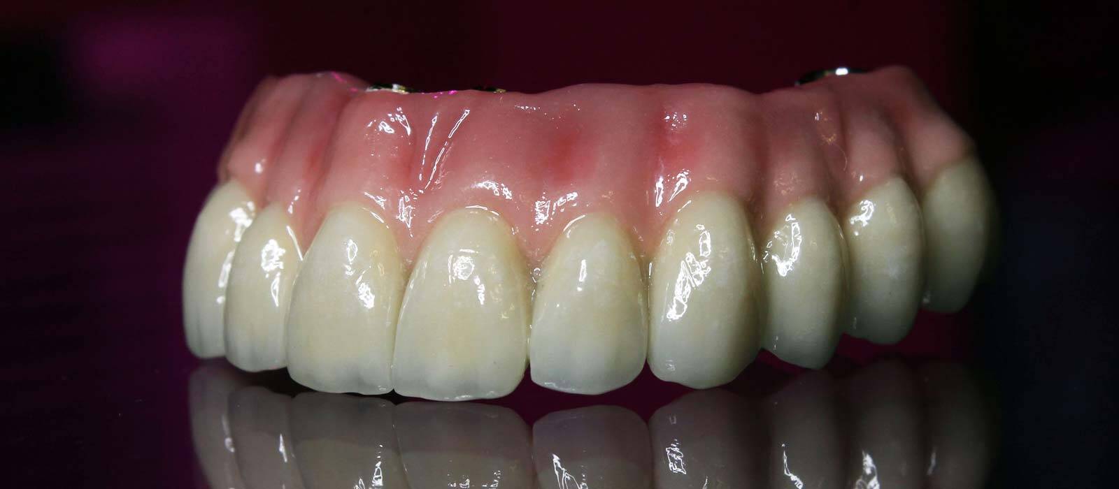 implant retained dentures - Amazing Smiles