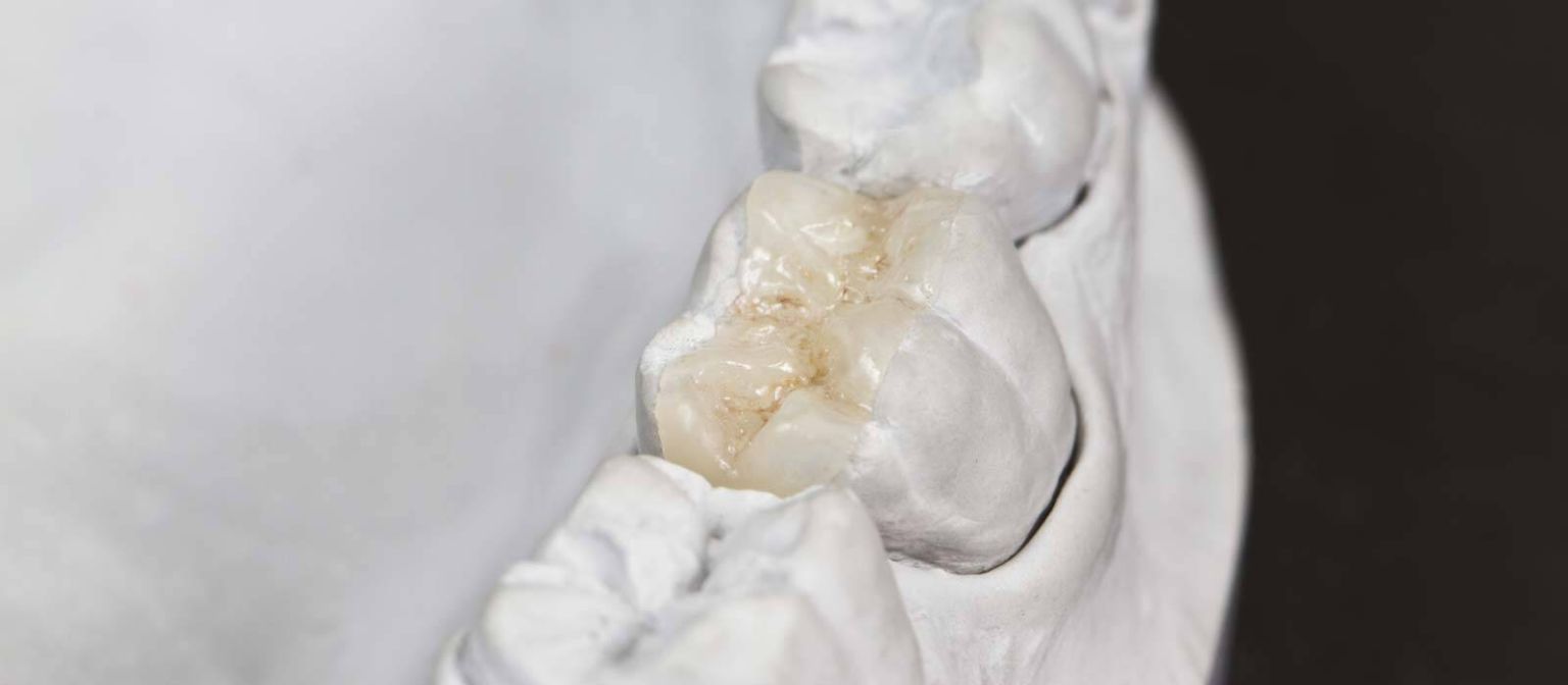 Fix Damaged Teeth: Restorative Dental Inlays & Dental Onlays