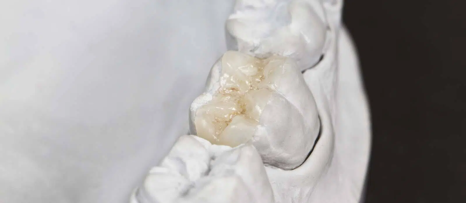 Fix Damaged Teeth: Restorative Dental Inlays & Dental Onlays