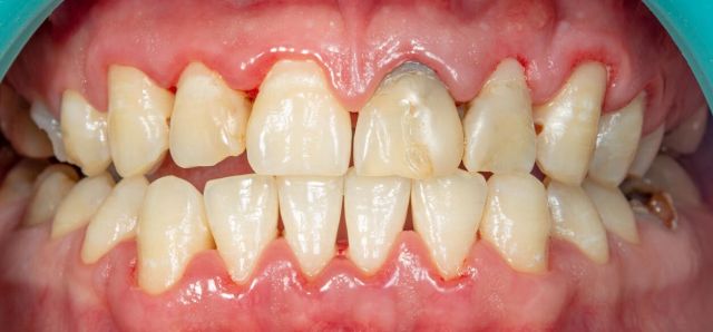 Periodontitis - Gum Disease: Symptoms, Causes, & Treatment