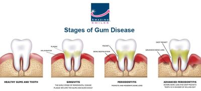What is Gingivitis? Symptoms, Prevention & Treatment Options