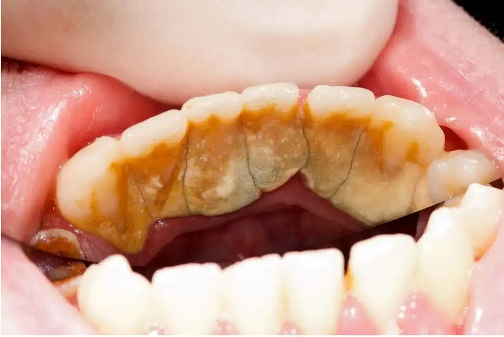 Understanding Plaque And Tartar Causes Risks Treatment