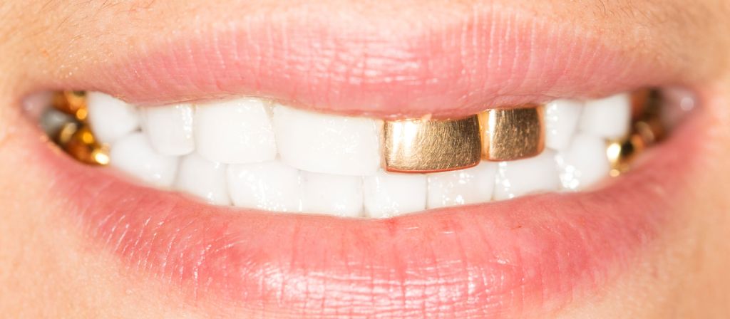 Silver Or Gold Dental Crown And Bridges - Amazing Smiles