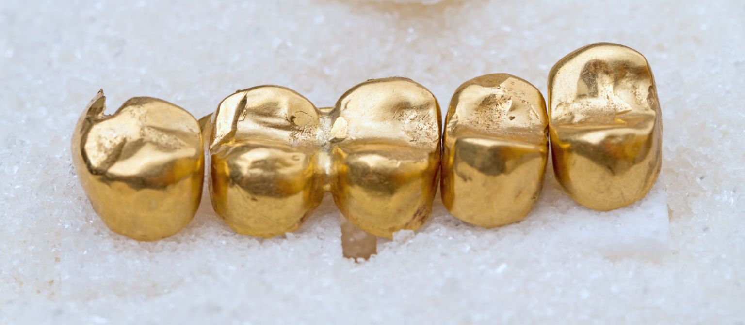 Silver Or Gold Dental Crown And Bridges - Amazing Smiles
