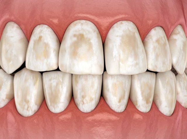 The Difference Between Demineralization And Tooth Erosion?