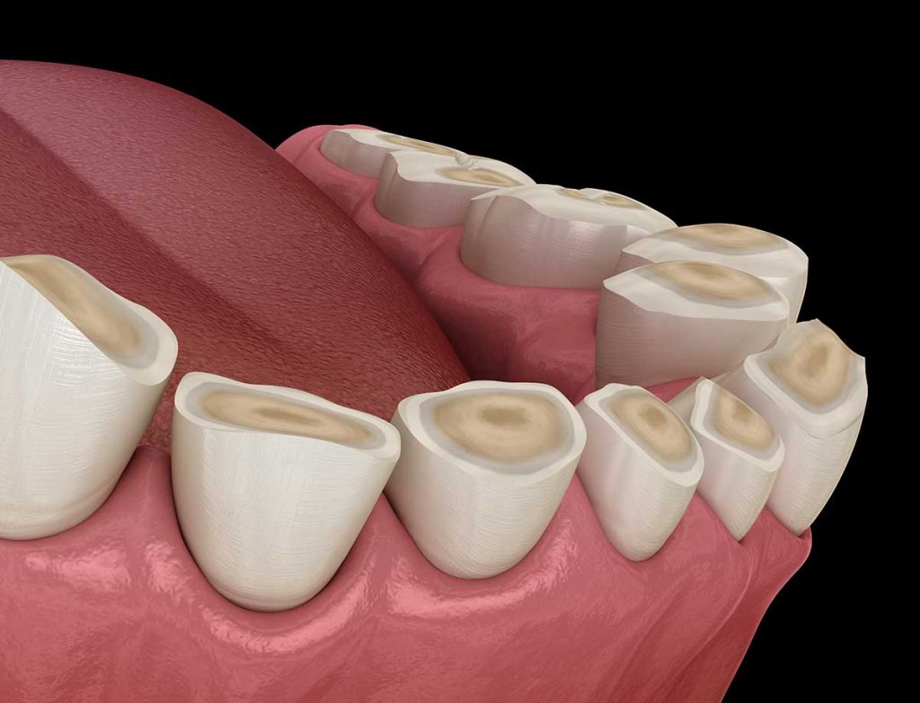 The Difference Between Demineralization And Tooth Erosion?