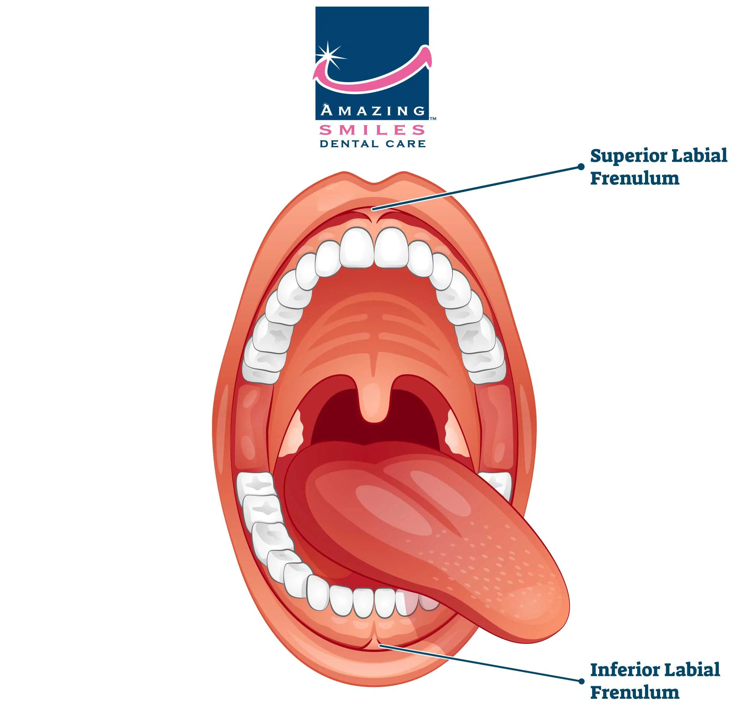 What Is A Frenum? How It Effects Oral Health - Oral Health & Hygiene ...