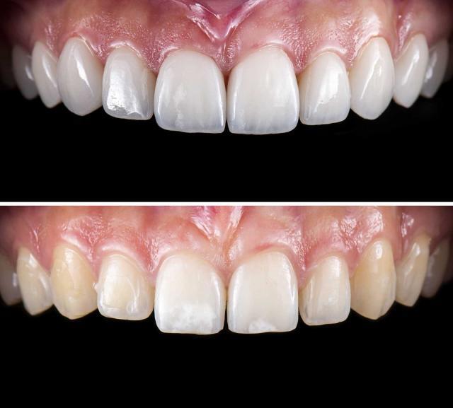 Enamel Hypocalcification: Causes, Symptoms, And Treatment