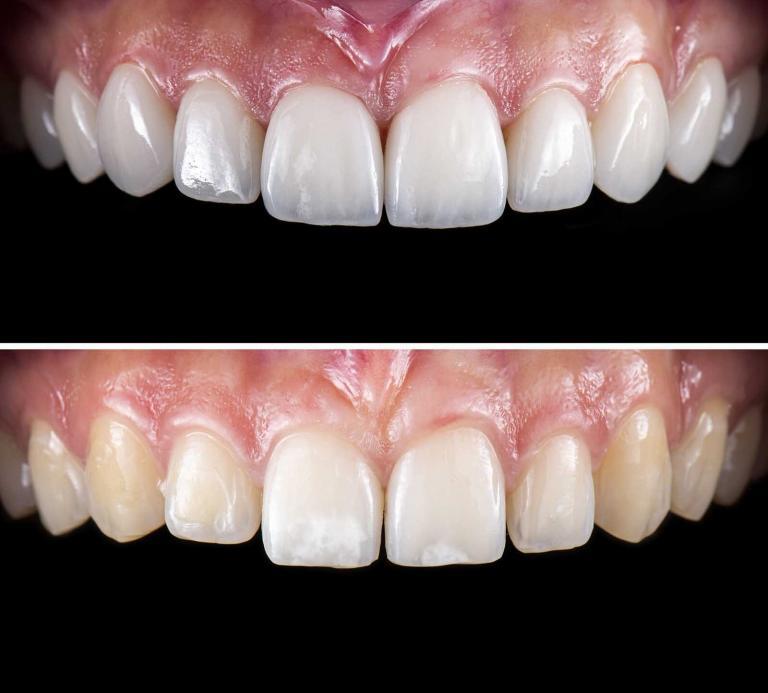 Enamel Hypocalcification: Causes, Symptoms, And Treatment