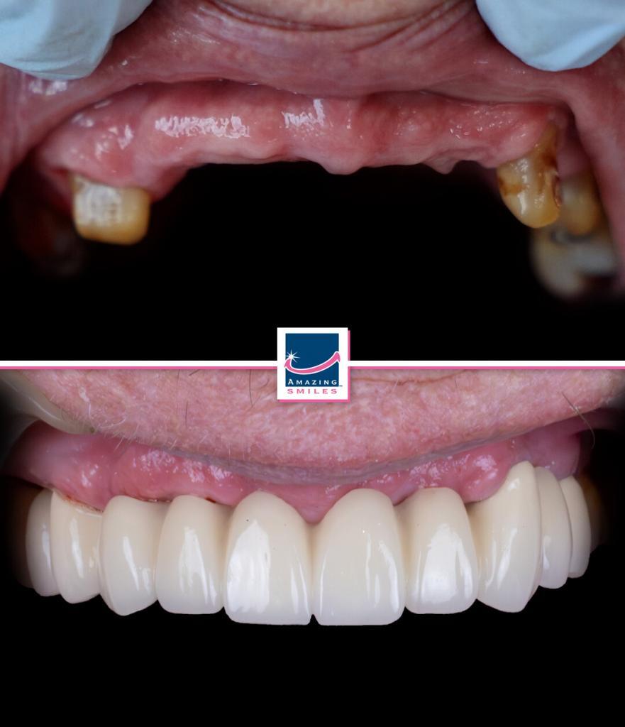 Options For Replacing Missing Teeth - Tooth Replacement