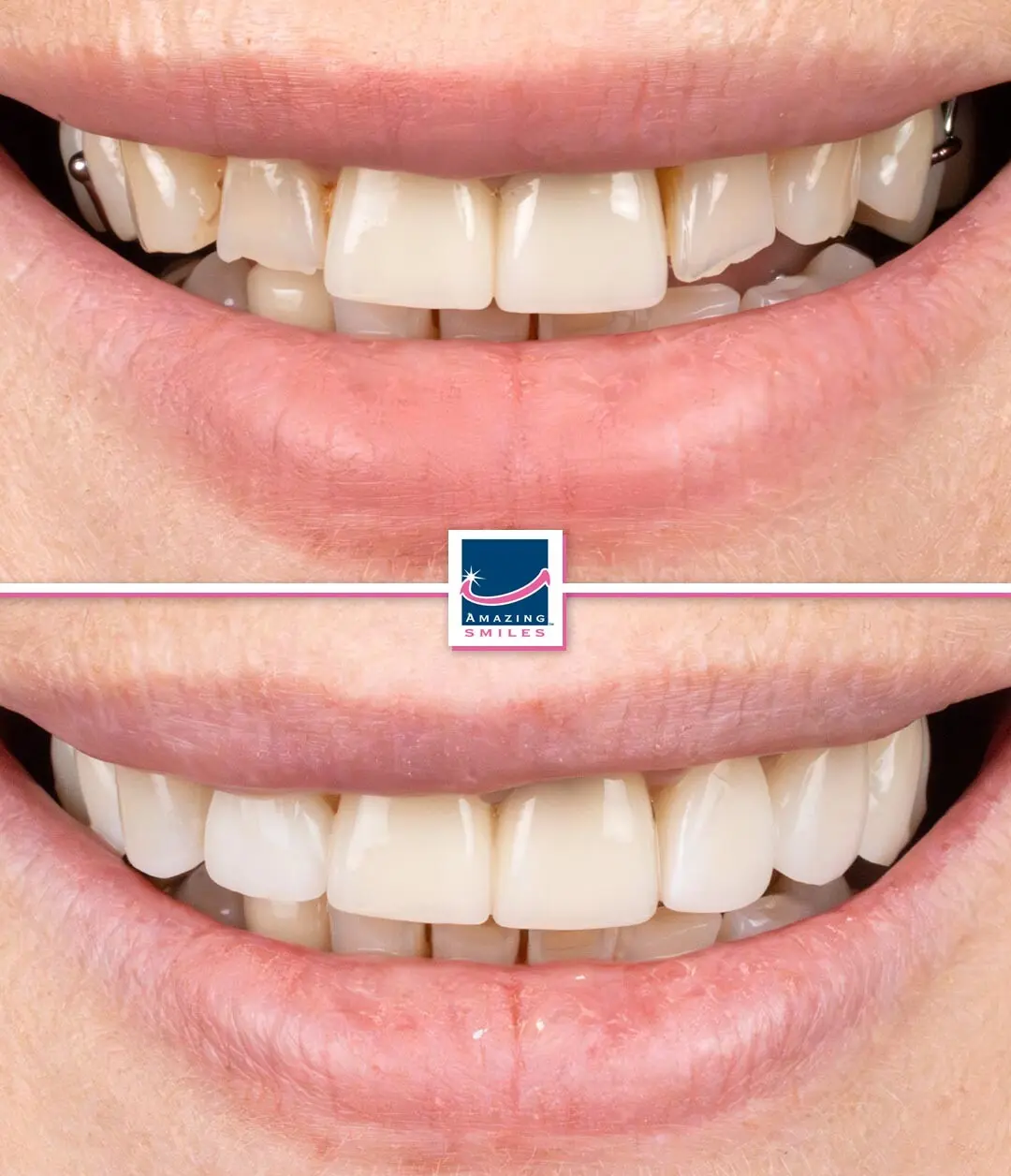 Composite Bonding - Amazing Smiles Cosmetic Dentist Near Me